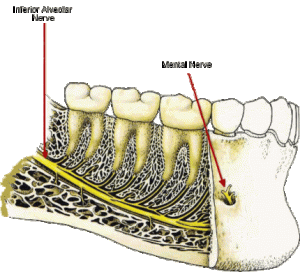 GAMADENTAL: PREVENCIÓN DE LA LESIÓN DEL NERVIO DENTARIO INFERIOR