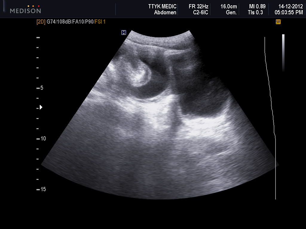 VIETNAMESE MEDIC ULTRASOUND: CASE 158: CYSTIC MASS NEARBY URINARY ...