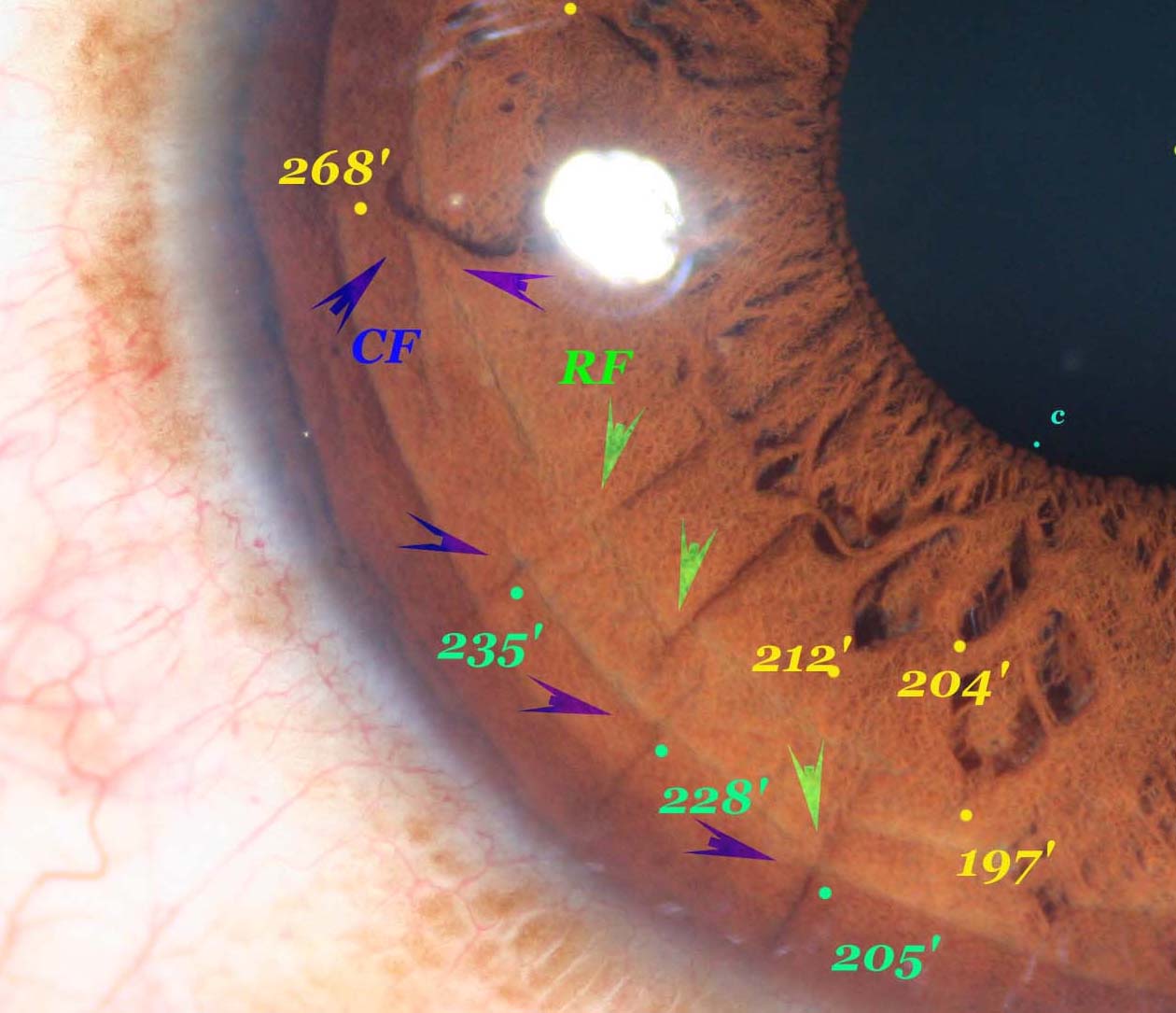 Modern & Multidimensional Iridology: Lacunae at External Border of the ...