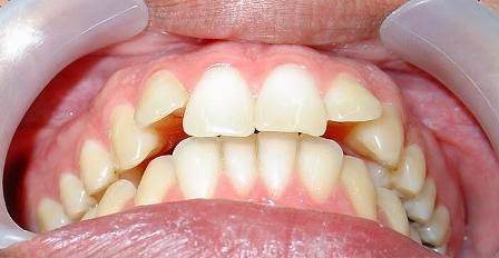 Odontologia Total: Classificação das Maloclusões de Angle