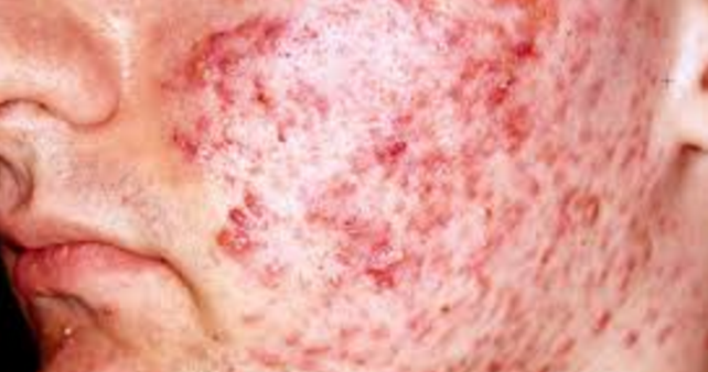 Acne Vulgaris Symptoms | Acne Vulgaris Blog