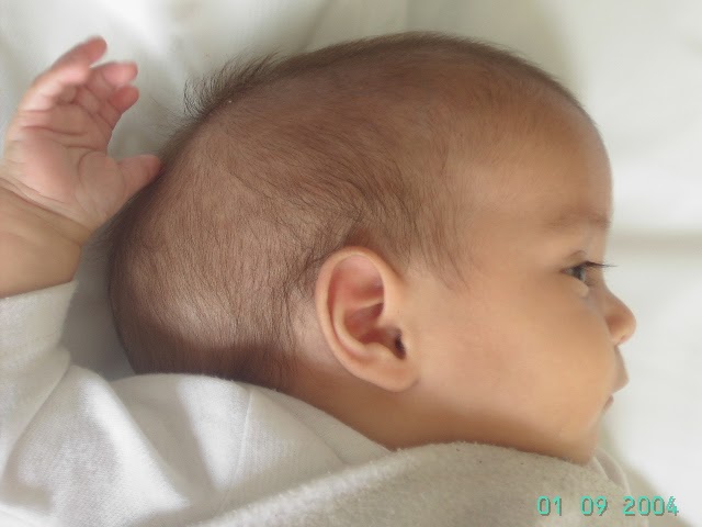 Craniosynostosis: Robert's Head: Unusual head-shape in babies