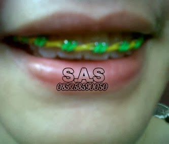 Foto Behel/Kawat Gigi (Fashions) Versi S.A.S AHLI GIGI PATI | AHLI GIGI ...