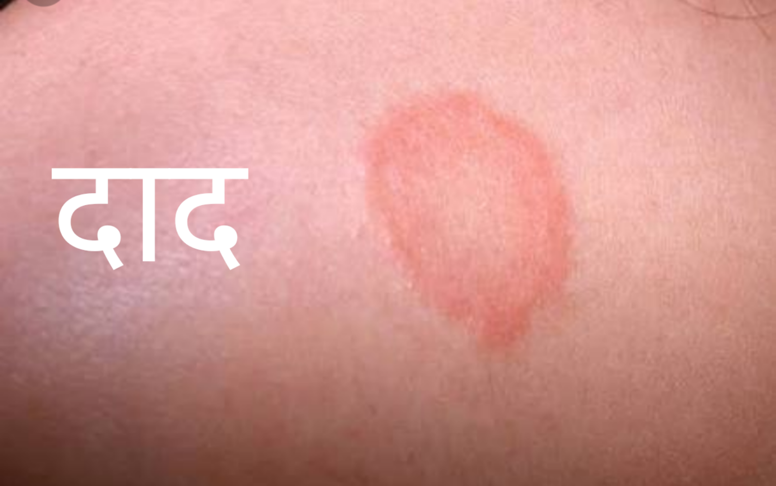 daad ke ilaj ke liye tablet aur cream- दाद का रामबाण इलाज