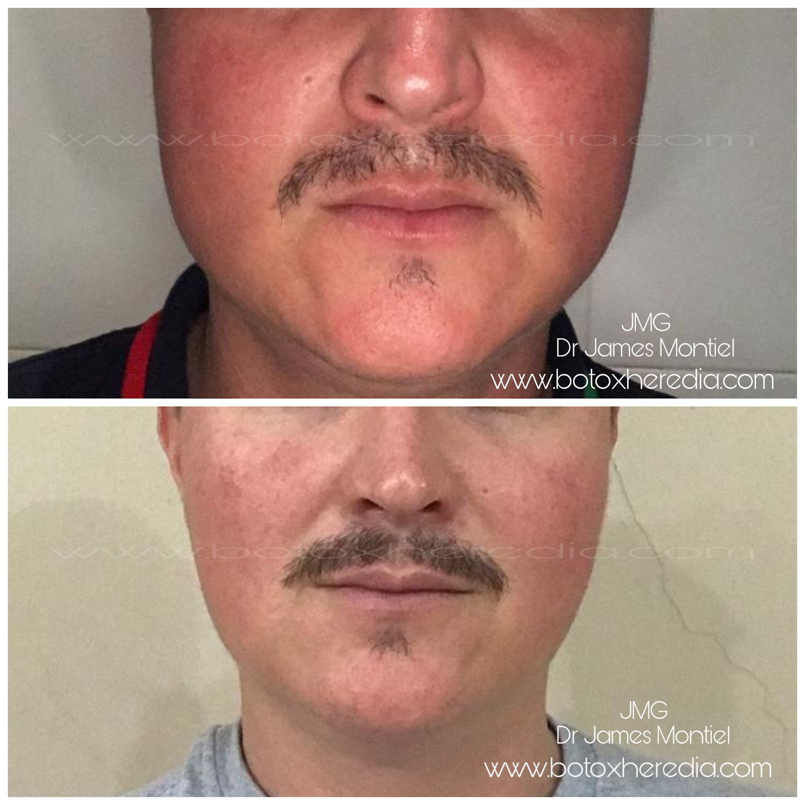 Botox, Acido Hialurónico, Bichectomia, Invisible Touch Hilos Pdo