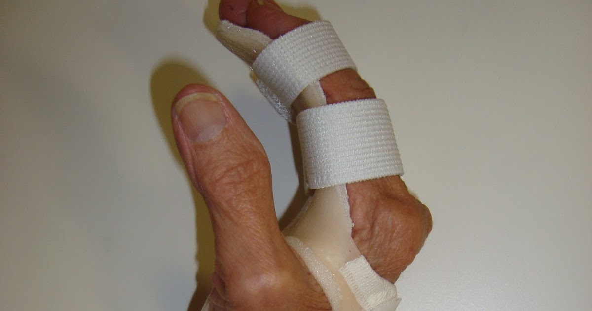 Orthèses sur mesure et appareillage personnalisé main poignet doigts ...