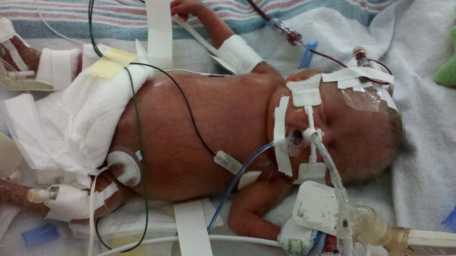 JAM sessions: Lessons learned through a micro-preemie: August 2013
