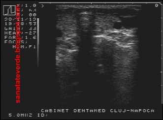 imagini ecografie esofag | Terapii naturiste si Tratamente