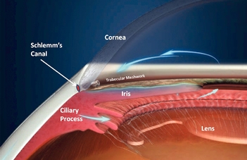 iStent® Implant for Glaucoma