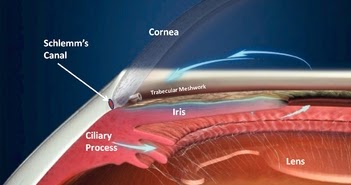 iStent® Implant for Glaucoma