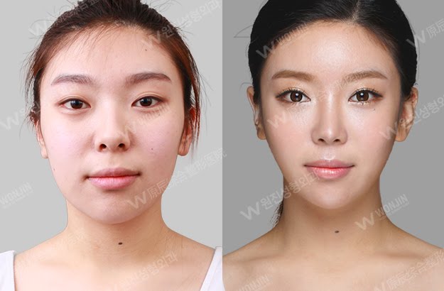 [Before and After Photos] Korean Rhinoplasty - 짱이뻐!