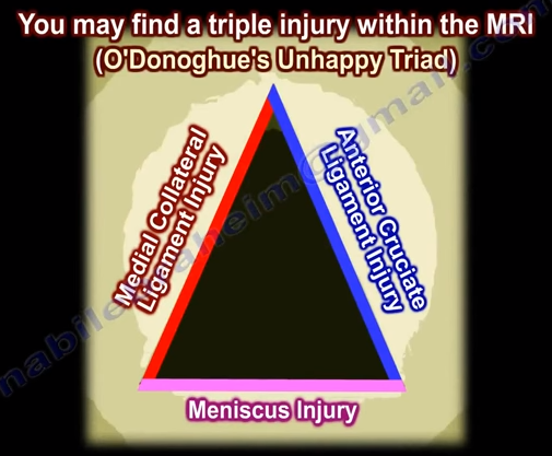 Dr. Nabil Ebraheim's Blogspot: Pivot Shift of the Knee—ACL tear