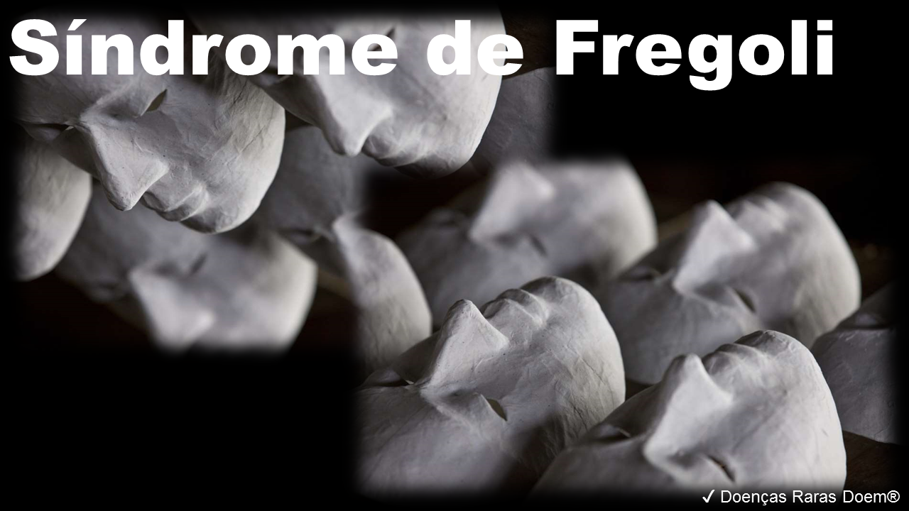Doenças Raras Doem®: Síndrome de Fregoli