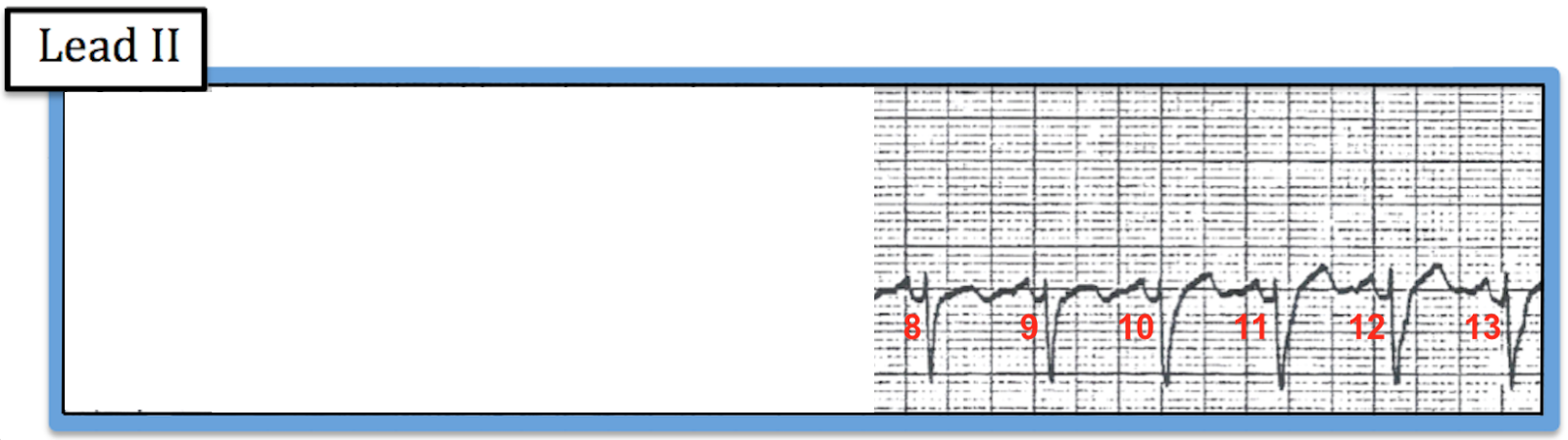 ECG Interpretation: ECG Blog #128 — VT, Fusion, WCT, Sinus Tach