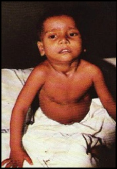 Falso crup- laringitis