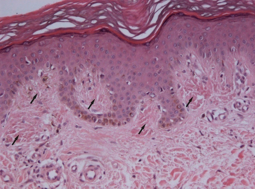 Cutaneous lichen amyloidosis within scratched areas | Russian Open ...