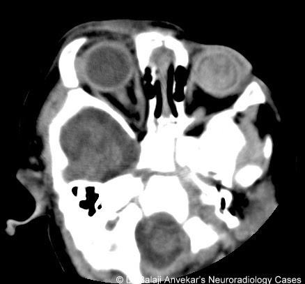Dr Balaji Anvekar FRCR: Persistent Hyperplastic Primary Vitreous