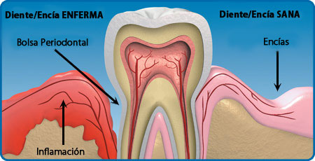 NUESTRA SALUD PERIODONTAL: Periodonto Sano