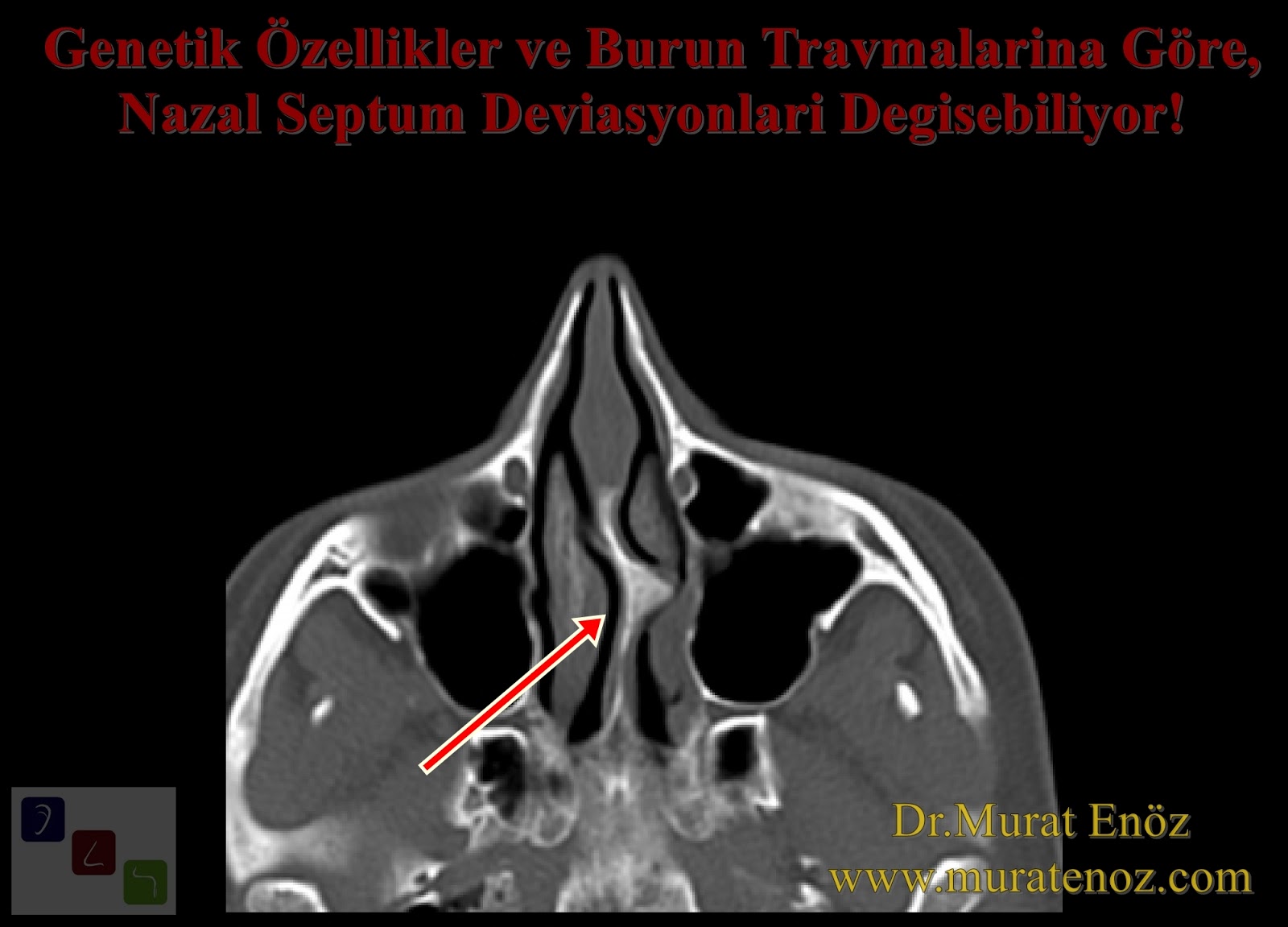 Genetik Özellikler ve Burun Travmalarına Göre, Nazal Septum ...
