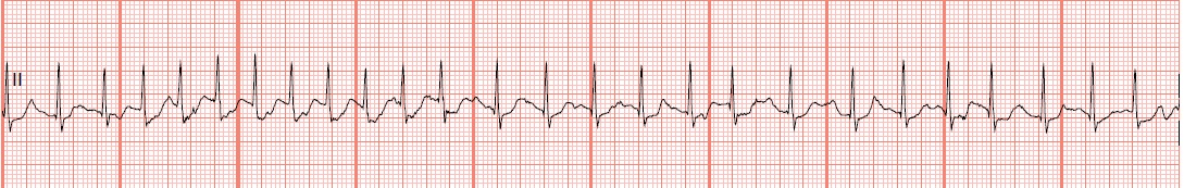 ECG Rhythm Strip Quiz 69