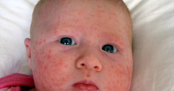 About Health: Rashes