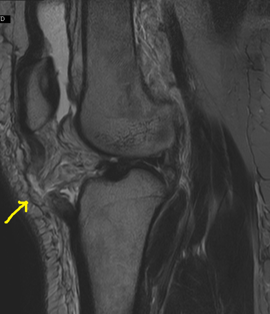 Patellar Tendon Rupture-MRI - Sumer's Radiology Blog