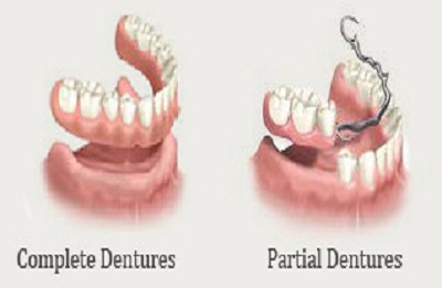 tooth crown: Complete Dentures