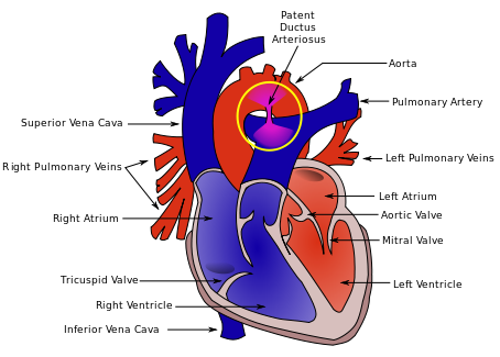 MedicoNotebook: Patent Ductus Arteriosus