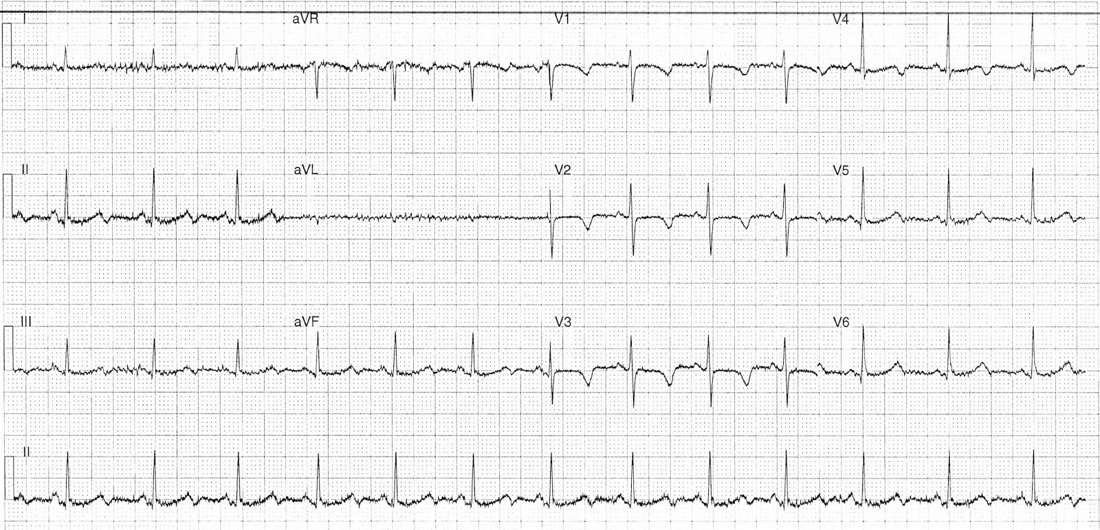 ECG of the Week: ECG of the Week - 25th July 2016 - Interpretation