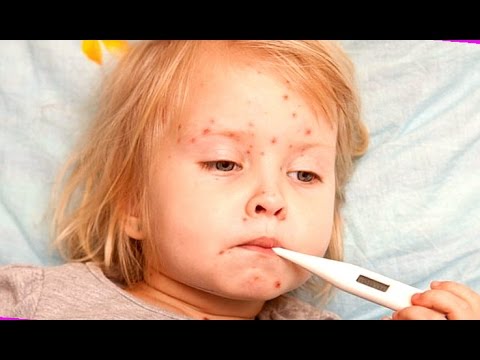 health and fitness: MEASLES : CAUSES, SYMPTOMS AND TREATMENT