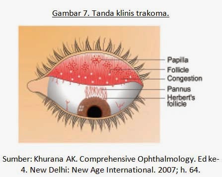 Obat Herbal Penyakit Mata Trakoma (Trachoma) | Blog Informasi Berita ...
