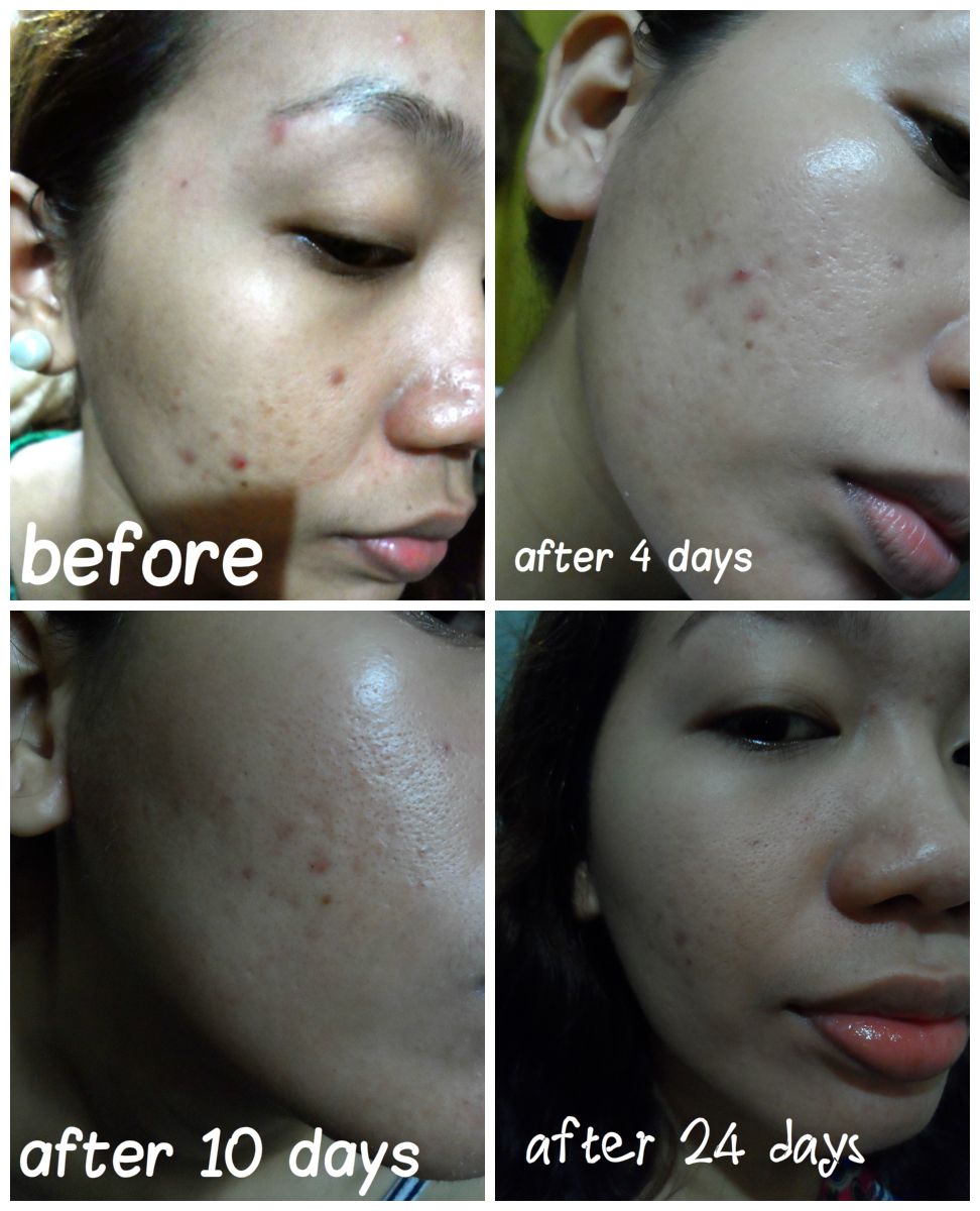 Prettythrifty: Maxi Peel Review : Before and After