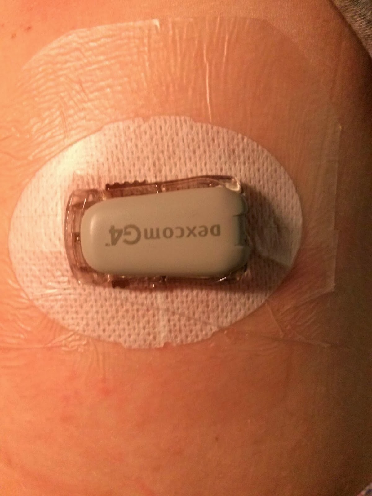 I am a Type 1 Diabetic Warrior: T:slim & Dexcom what are they?