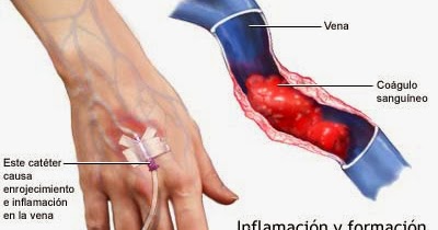 Alteraciones y enfermedades : Flebitis