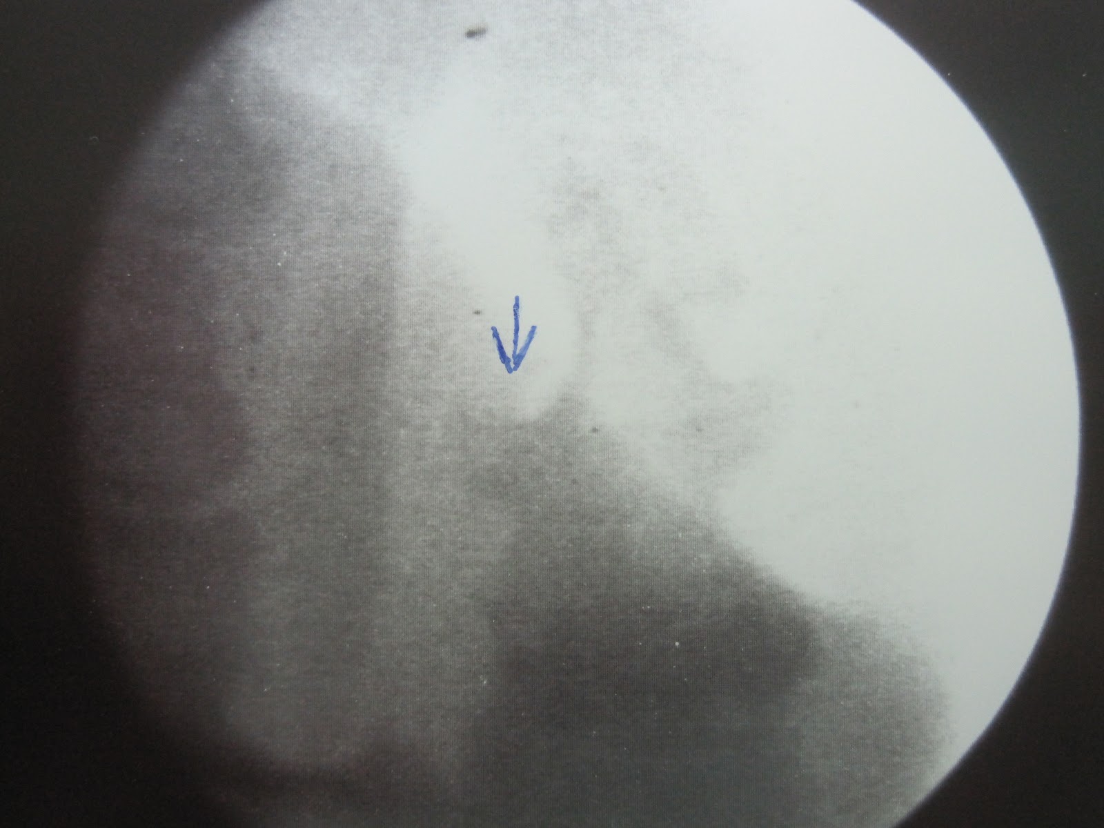 Podo Basas al Día: Heloma interdigital, ojo de gallo, callo ...