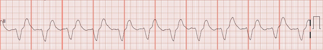 EKG Rhythm Strip Quiz 55: Ventricular Rhythms
