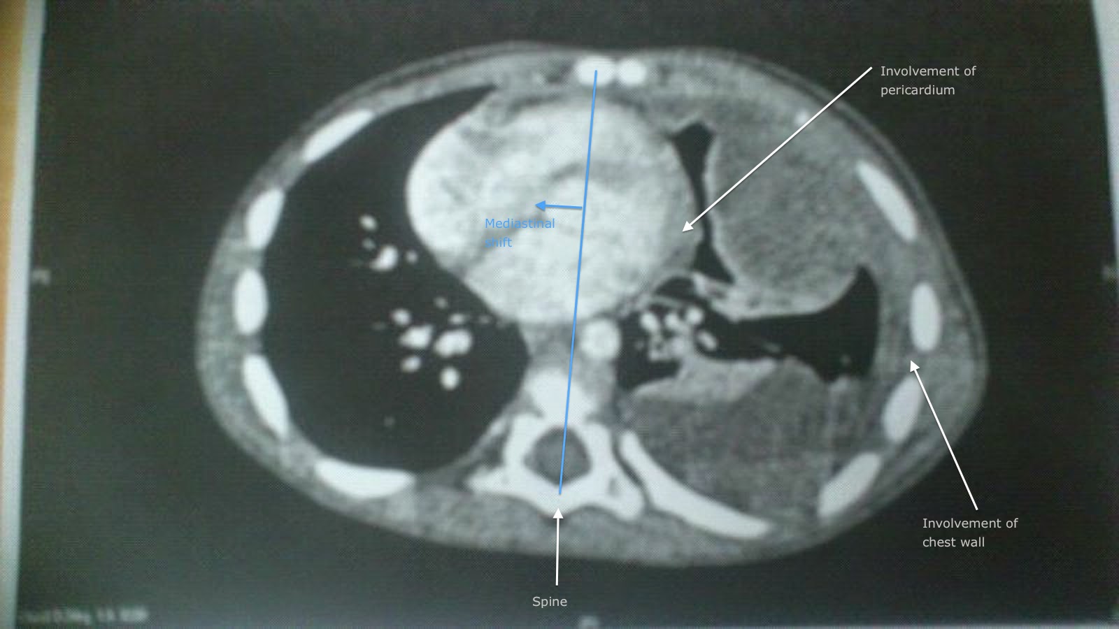 Medical Treatment Pictures-for Better Understanding: Sarcoma - Adult ...