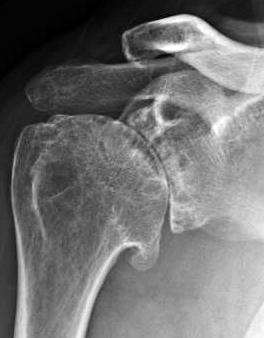 Shoulder Arthritis / Rotator Cuff Tears: causes of shoulder pain: Can ...