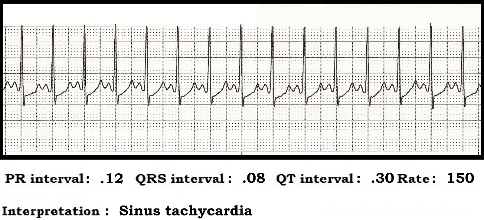 ECG Rhythm Strip Quiz 89: Interval measurements