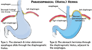 Hiatus Hernia: What is paraesopahgeal hiatus hernia?