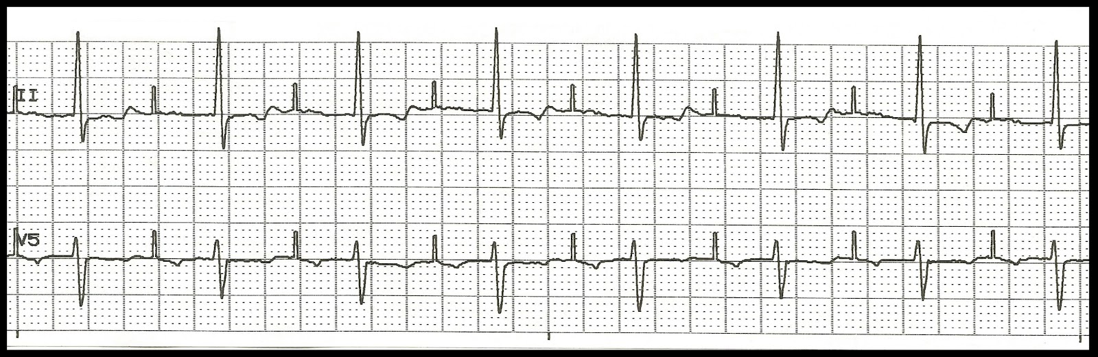 Practice EKG Rhythm Strips 125