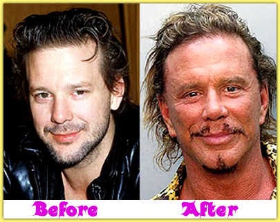 Mickey Rourke Face Plastic Surgery Gone Wrong Before and After Pictures