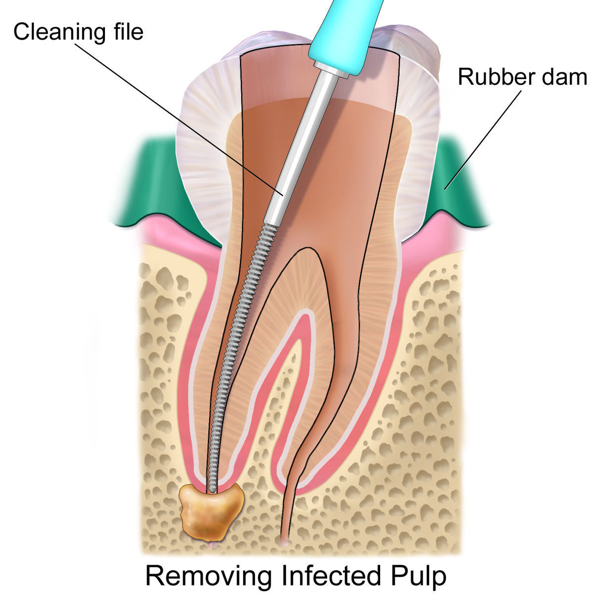 Root Canals root-canals