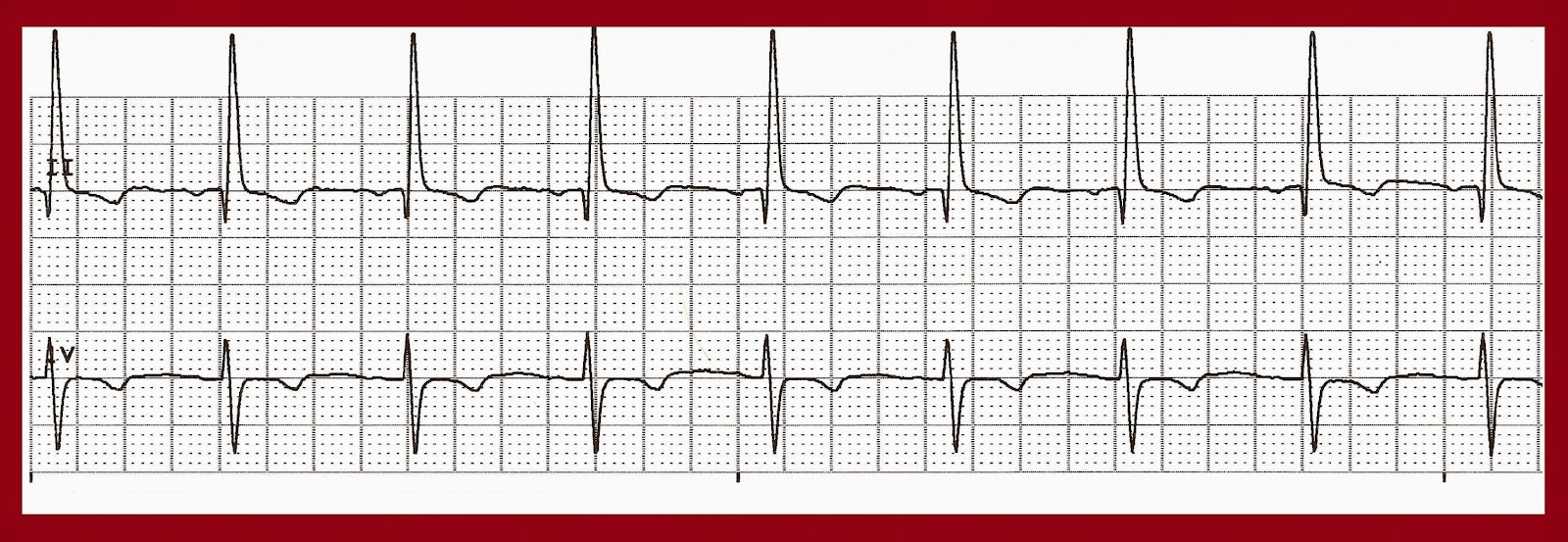 Float Nurse: Practice EKG Strips 427