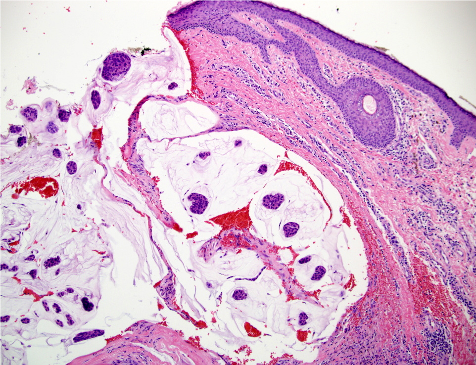 PATHfinder: An approach to skin adnexal neoplasms.