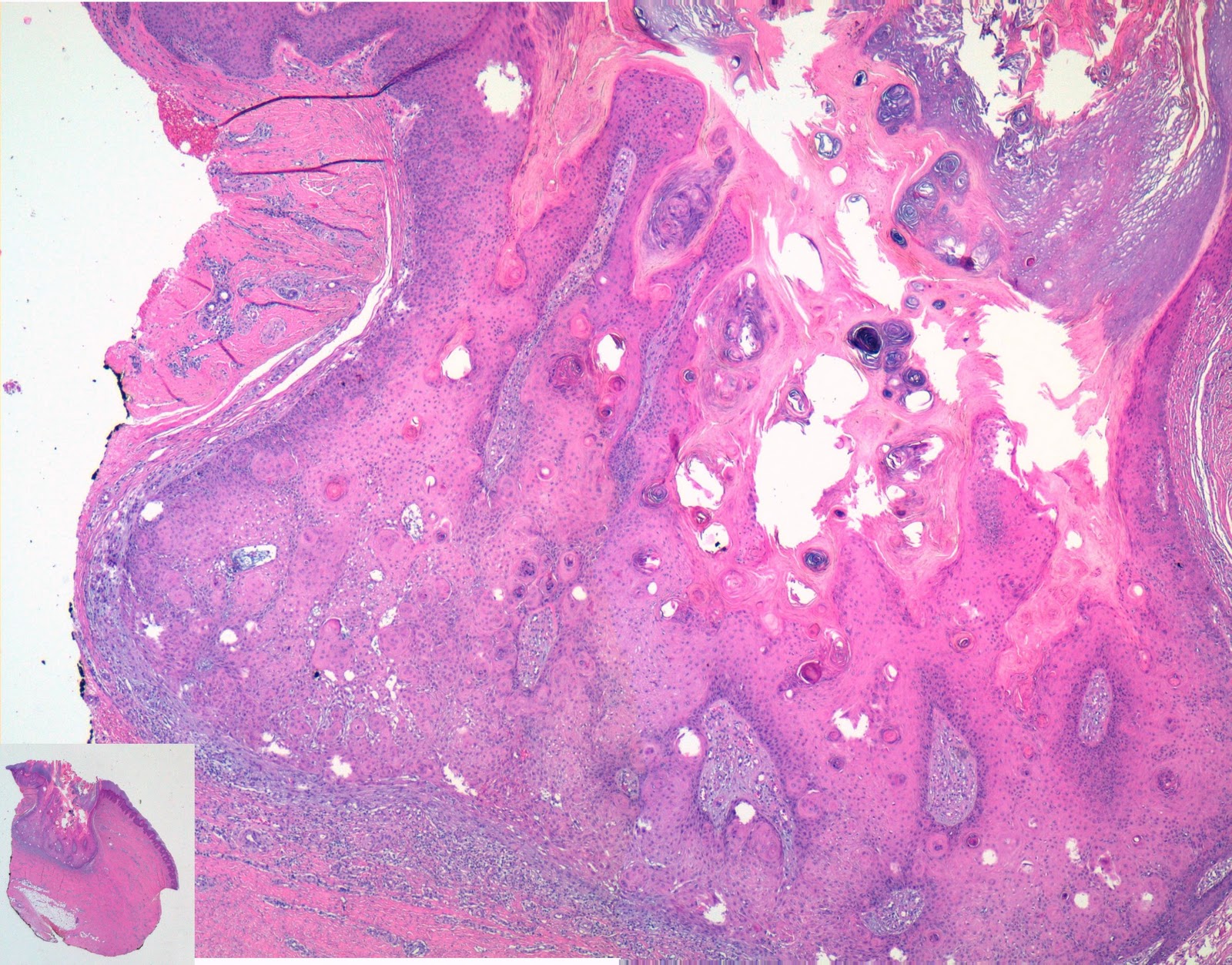PATHfinder: Surgical Pathology Snapshot #7: skin lesion, leg.