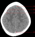 Dr Herry Setya Yudha Utama SpB. FInaCS. MHKes. ICS: Seri Bedah Saraf ...