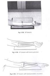 Proyeksi Pemeriksaan Antebrachii | Aditya Radiografer