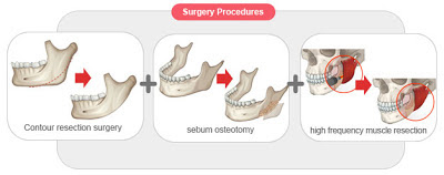 ID Hospital Korea: Prominent Mandible Angle