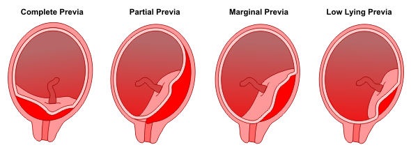 PLACENTA PREVIA | emergencias obstetricas